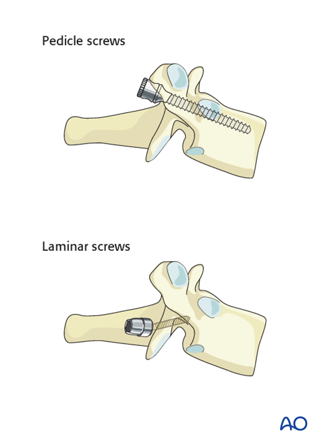 Cervicothoracic junction - posterior fixation for C Translational injury