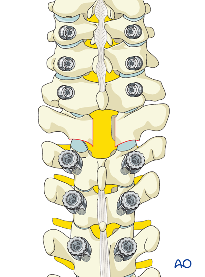 Cervicothoracic junction - posterior fixation for C Translational injury