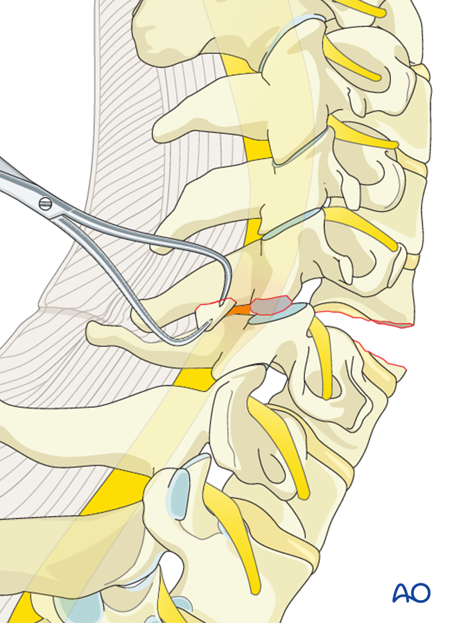 Cervical spine - posterior fixation for B3 Anterior tension band injury