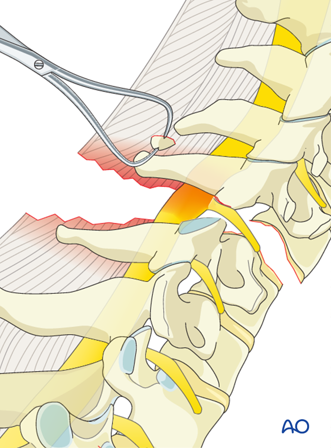 Cervical spine - posterior fixation for C Translational injury