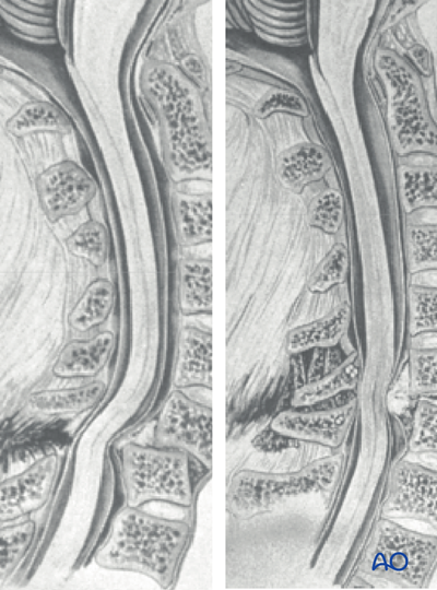 Cervical spine - posterior fixation for C Translational injury