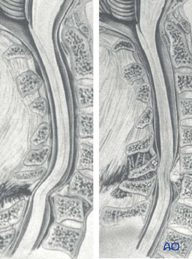 Cervical spine - posterior fixation for C Translational injury
