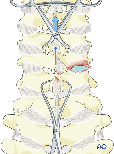 Cervical spine - posterior fixation for C Translational injury