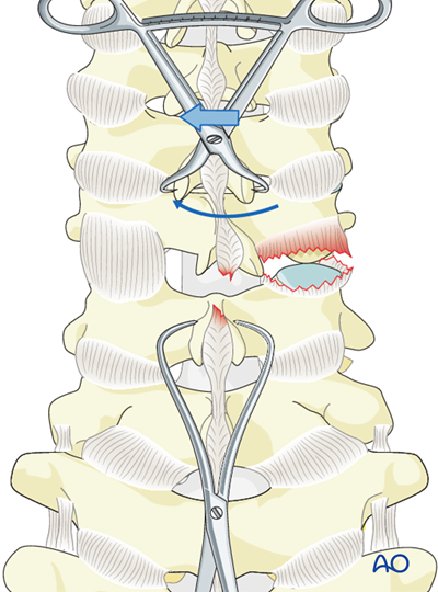 Cervical spine - posterior fixation for C Translational injury