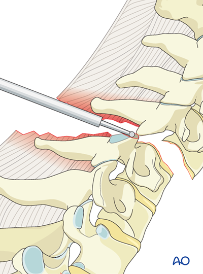 Cervical spine - posterior fixation for C Translational injury