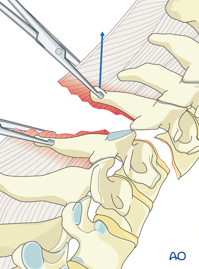 Cervical spine - posterior fixation for C Translational injury