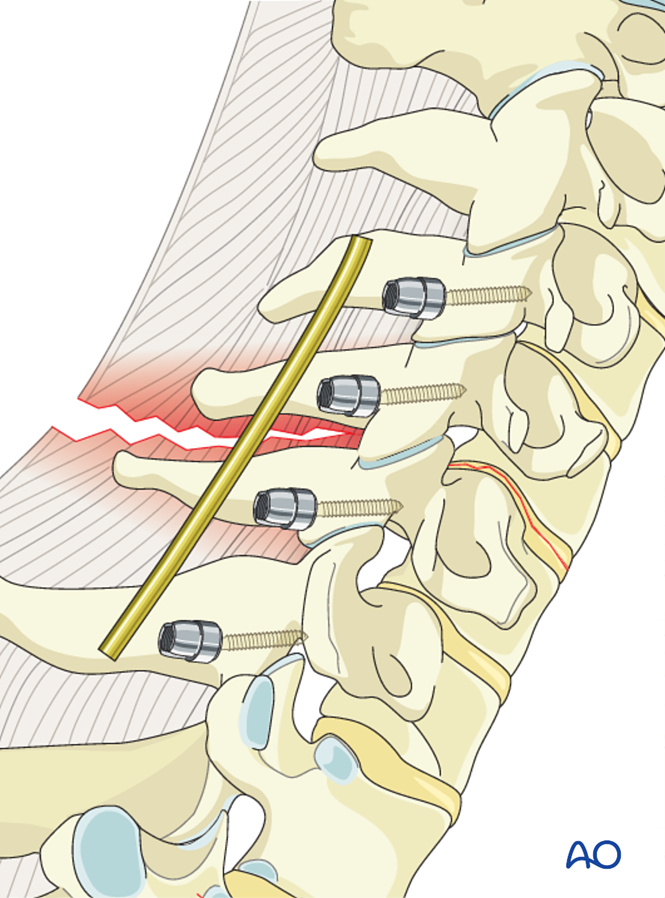 Cervical spine - posterior fixation for C Translational injury