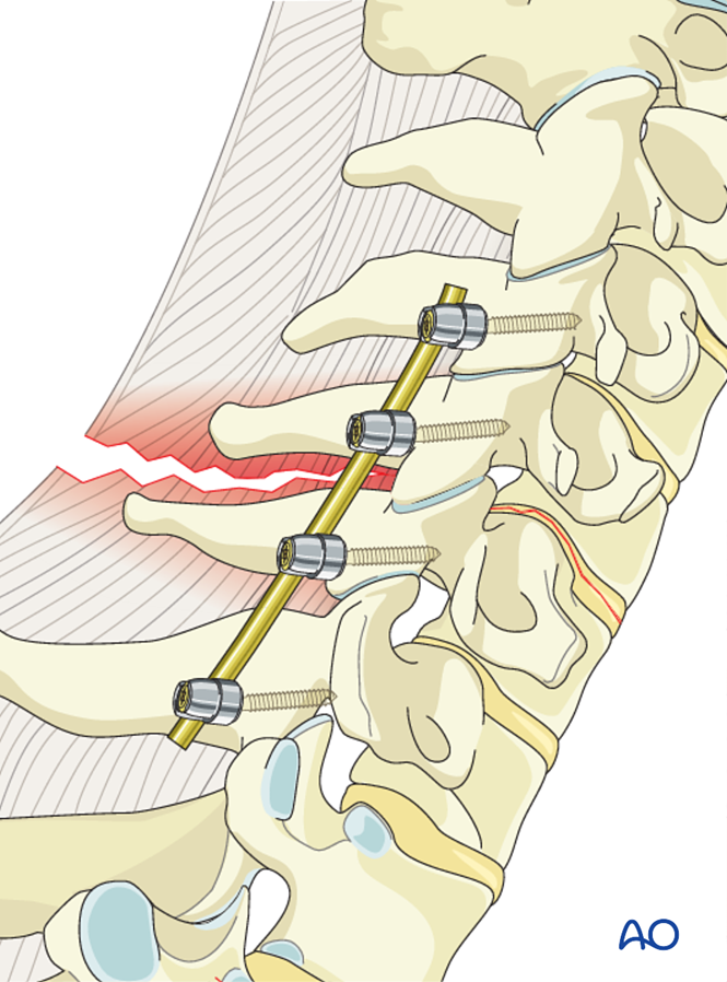 Cervical spine - posterior fixation for C Translational injury