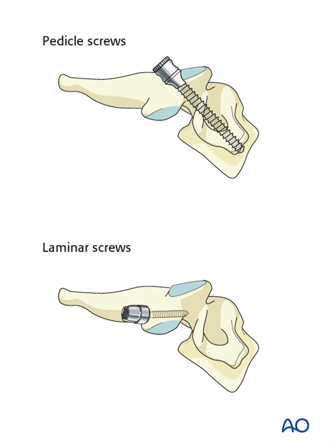 Cervical spine - posterior fixation for C Translational injury