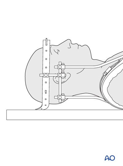 Cervical spine - posterior fixation for C Translational injury