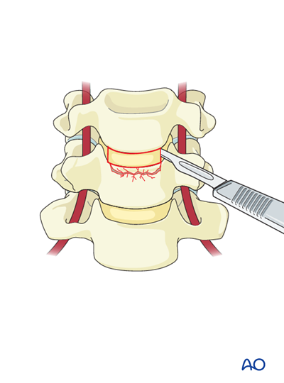 Anterior plating for A1 Compression fracture single endplate