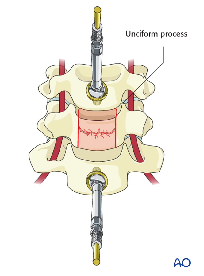 Anterior plating for A1 Compression fracture single endplate