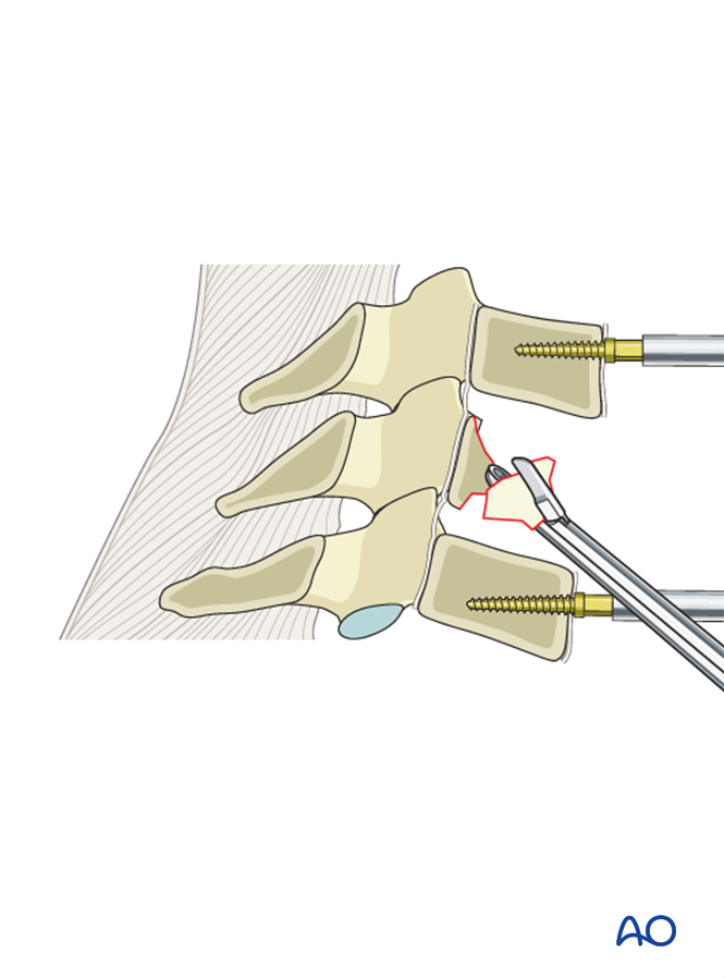 Anterior plating for A1 Compression fracture single endplate