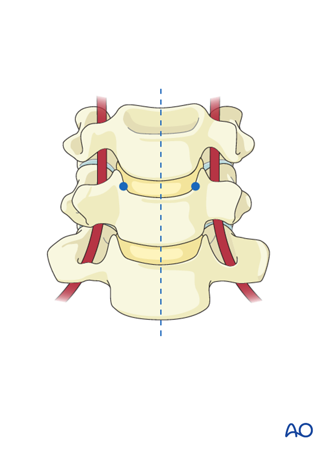Anterior plating for A2 Coronal split/pincer fracture