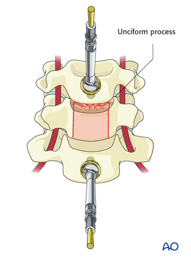 Anterior plating for A2 Coronal split/pincer fracture