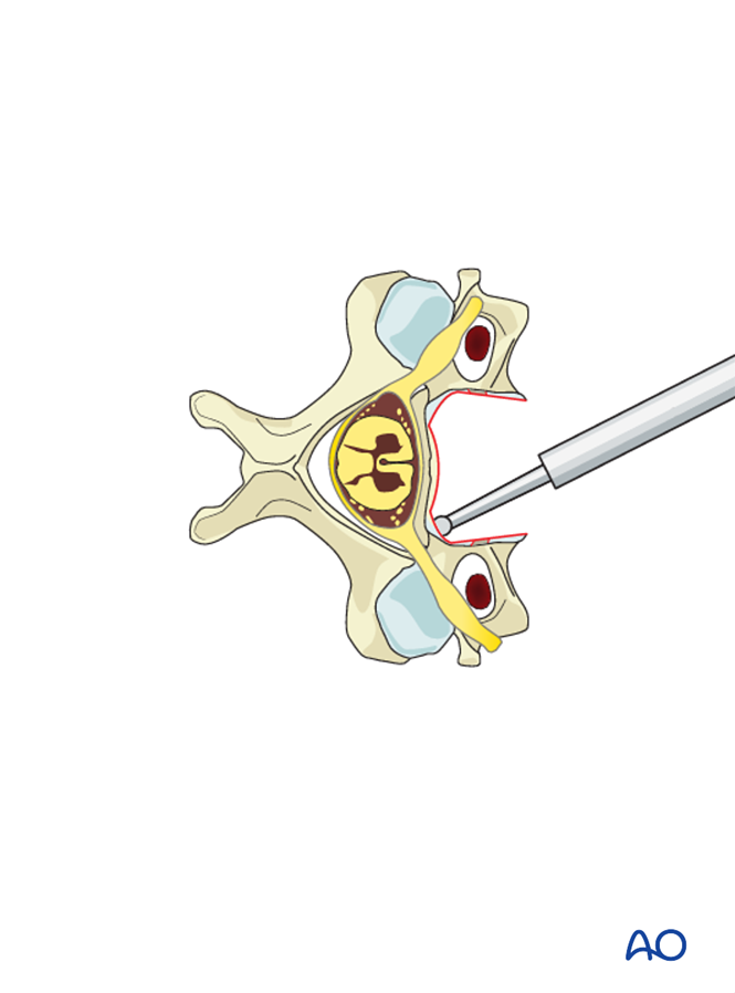Anterior plating for A2 Coronal split/pincer fracture