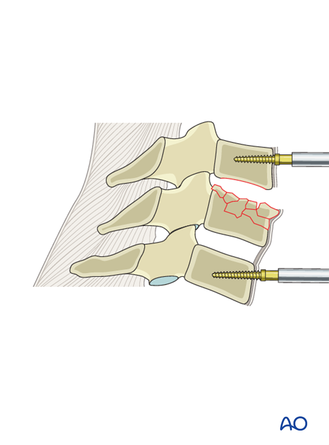 Anterior plating for A3 Burst fracture of single endplate