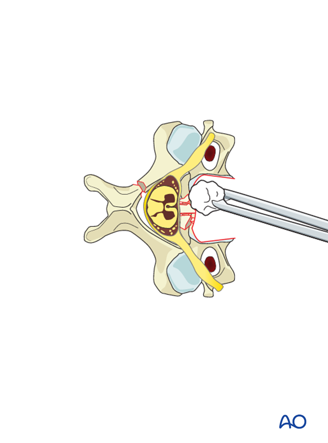 Anterior plating for A3 Burst fracture of single endplate