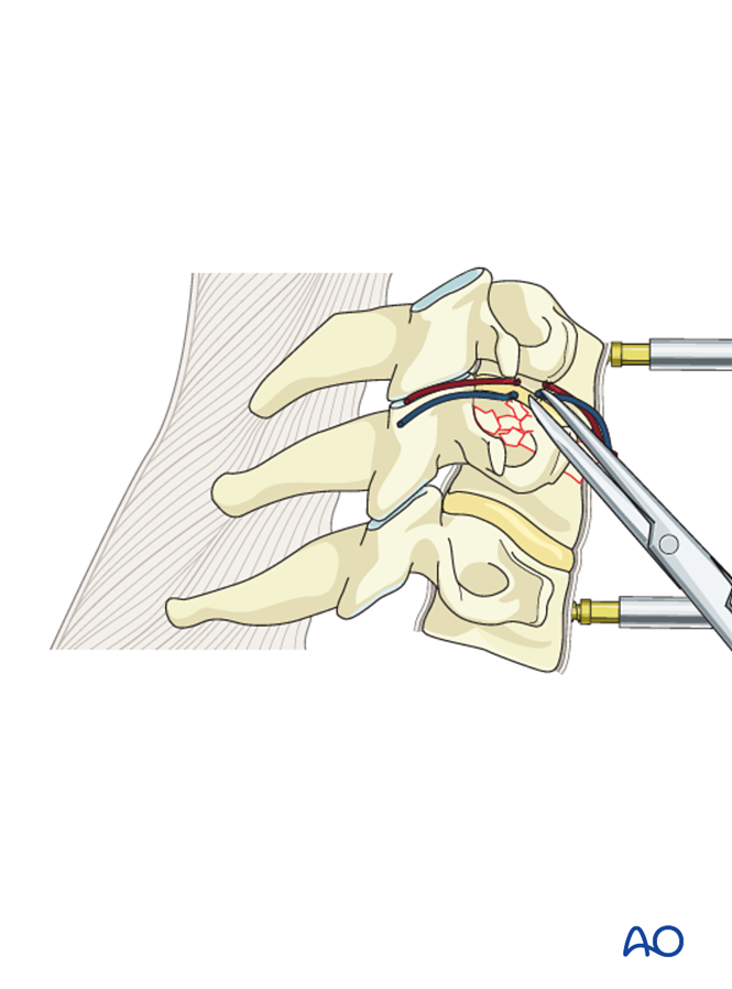 Anterior plating for A3 Burst fracture of single endplate