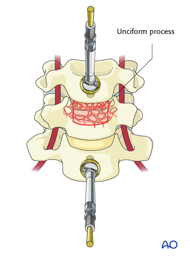 Anterior plating for A3 Burst fracture of single endplate