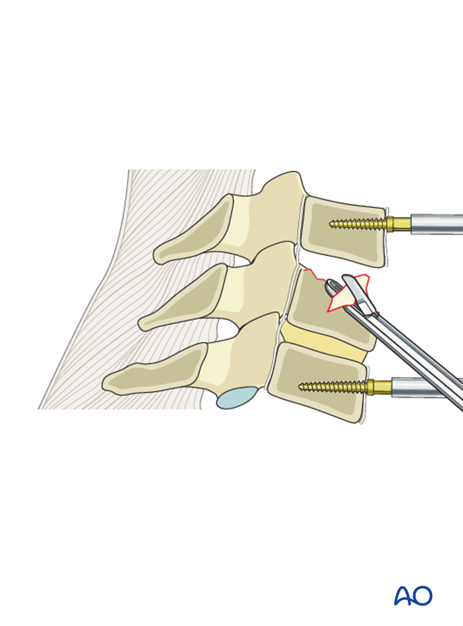 Anterior plating for A3 Burst fracture of single endplate