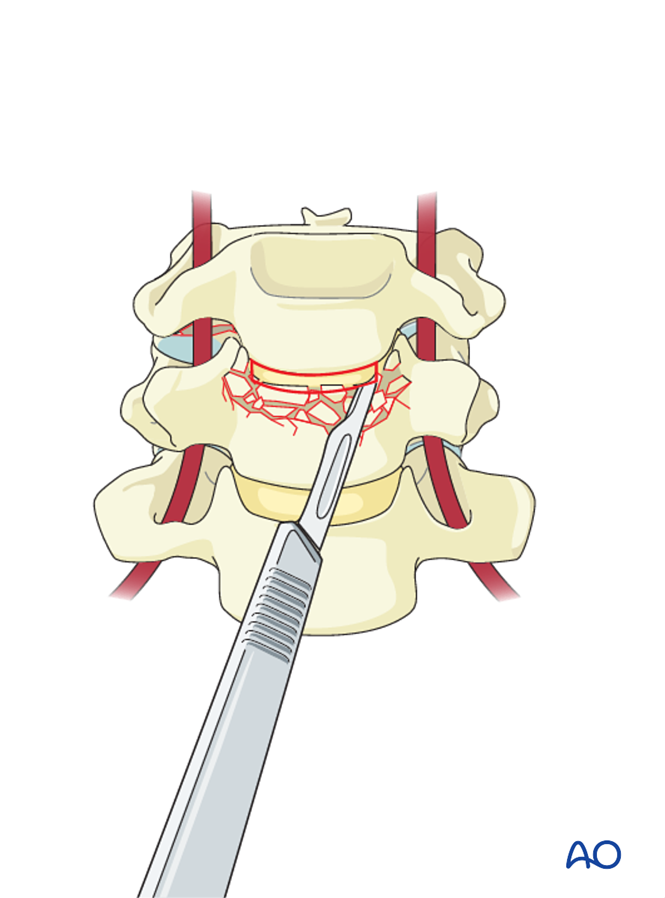 Anterior plating for B2 Posterior tension band injury (bony ...