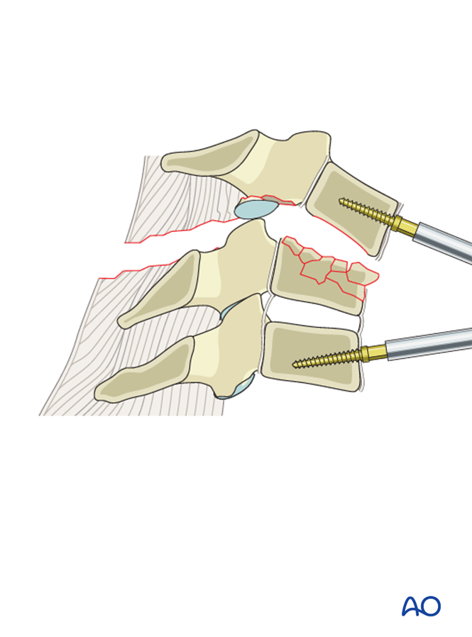 Anterior plating for B2 Posterior tension band injury (bony ...