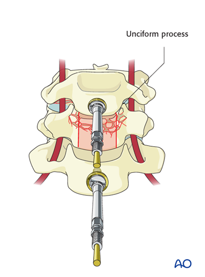 Anterior plating for B2 Posterior tension band injury (bony ...