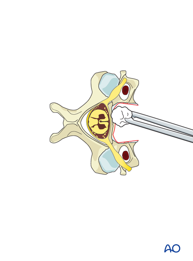 Anterior plating for B2 Posterior tension band injury (bony ...