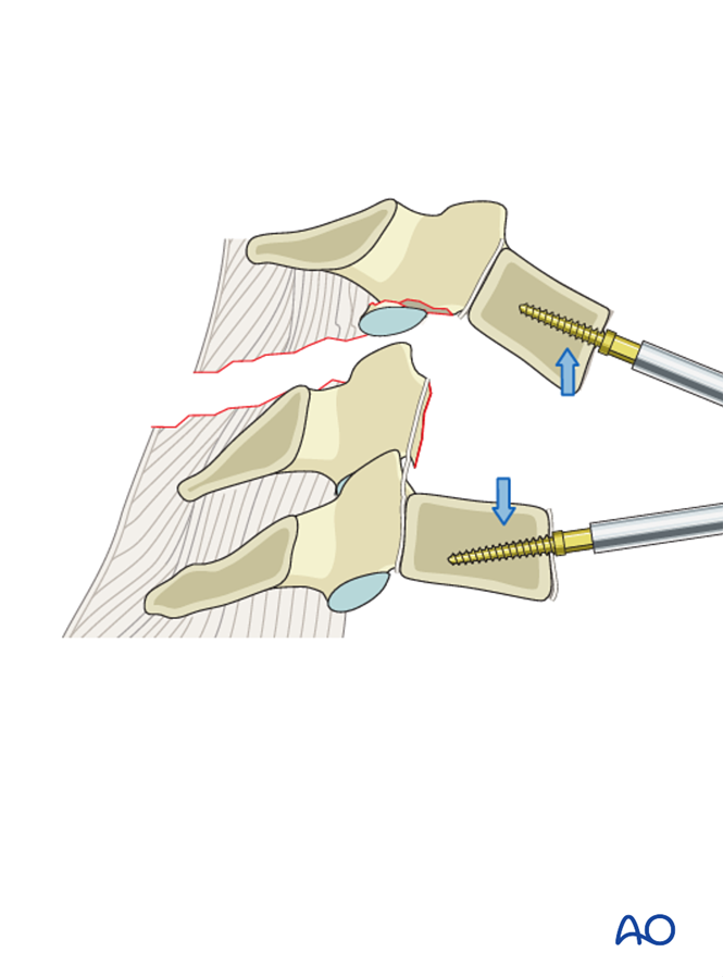 Anterior plating for B2 Posterior tension band injury (bony ...