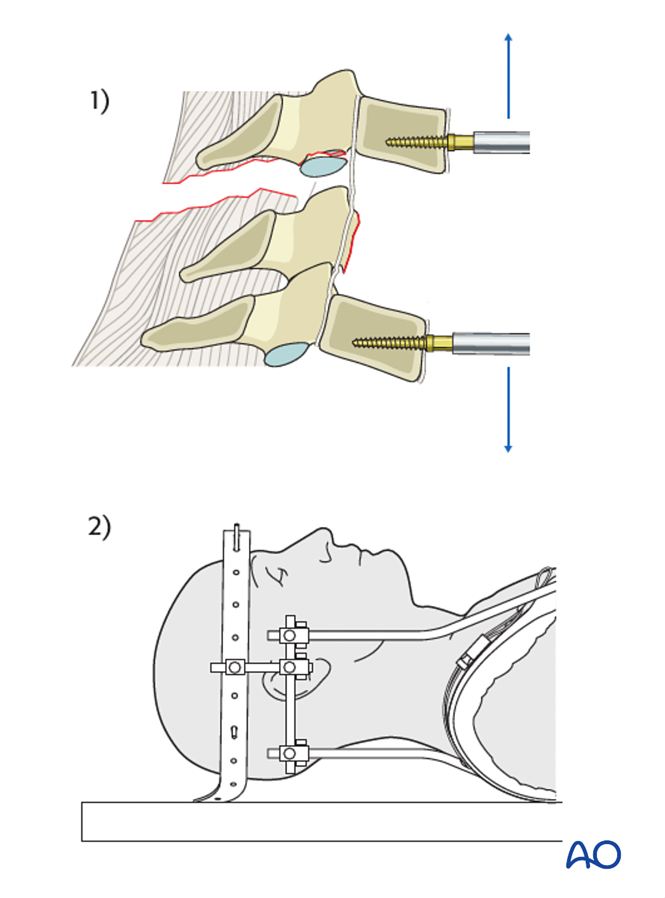 Anterior plating for B2 Posterior tension band injury (bony ...