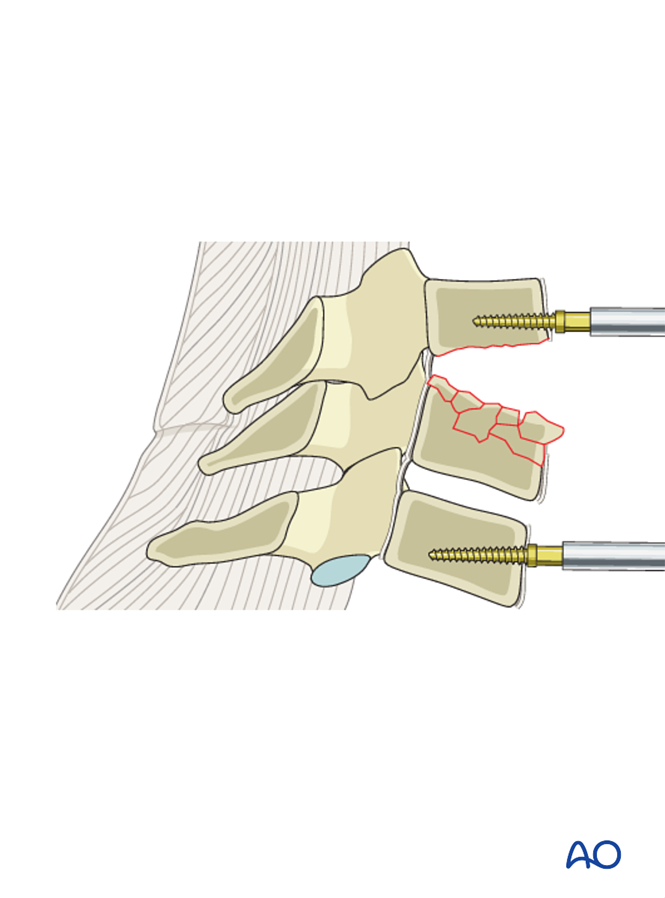 Anterior plating for B3 Anterior tension band injury