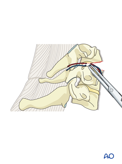 Anterior plating for B3 Anterior tension band injury