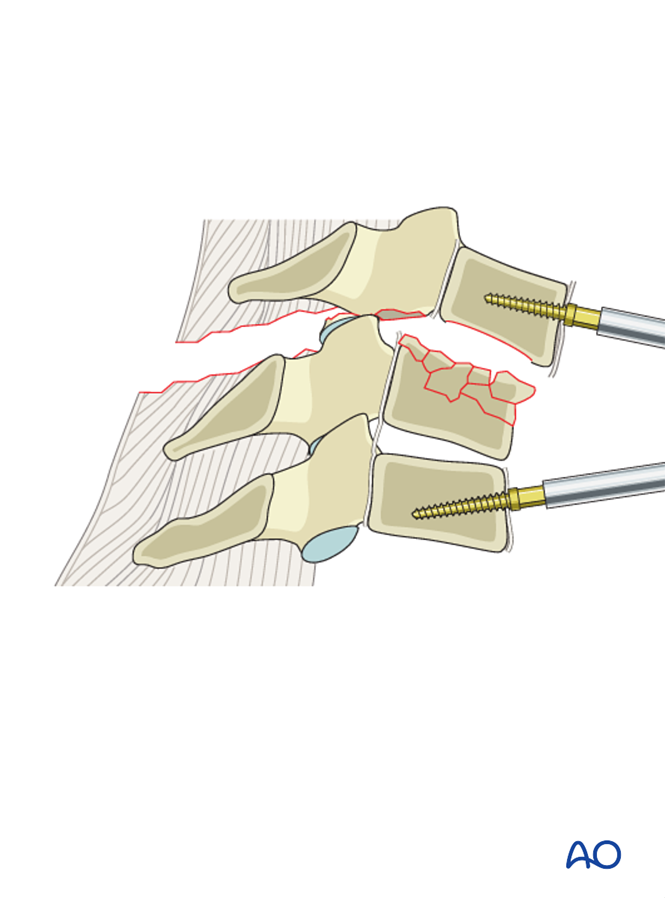 Anterior plating for C Translational injury
