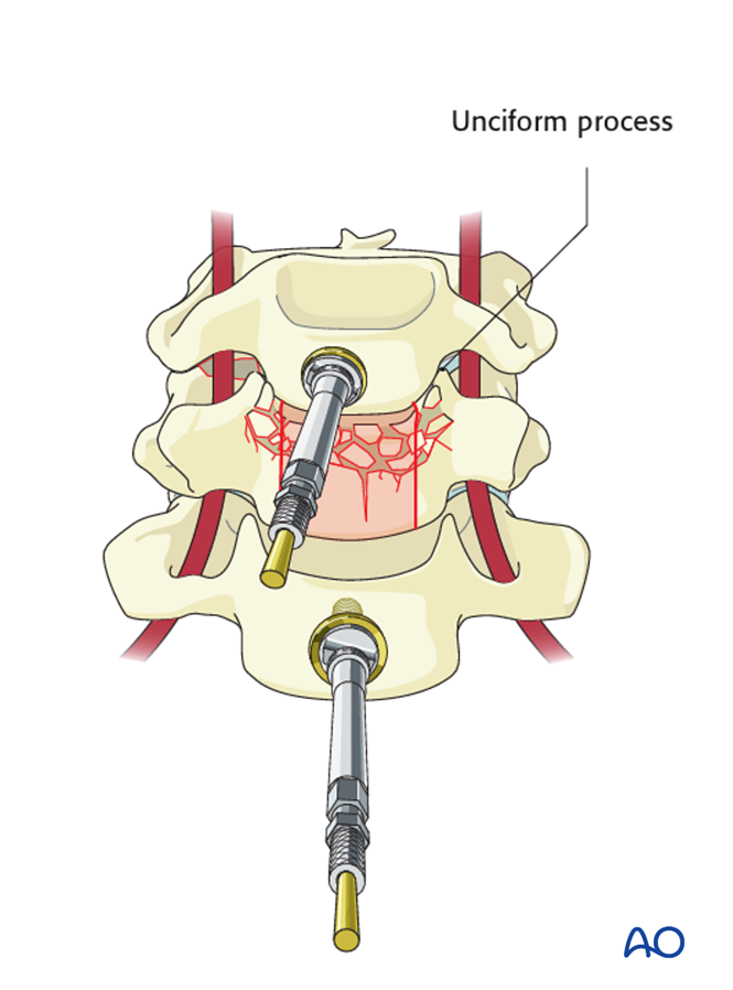 Anterior plating for C Translational injury