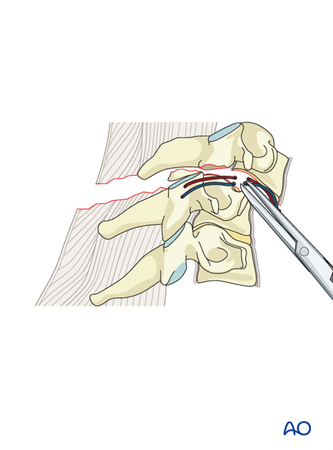 Anterior plating for C Translational injury
