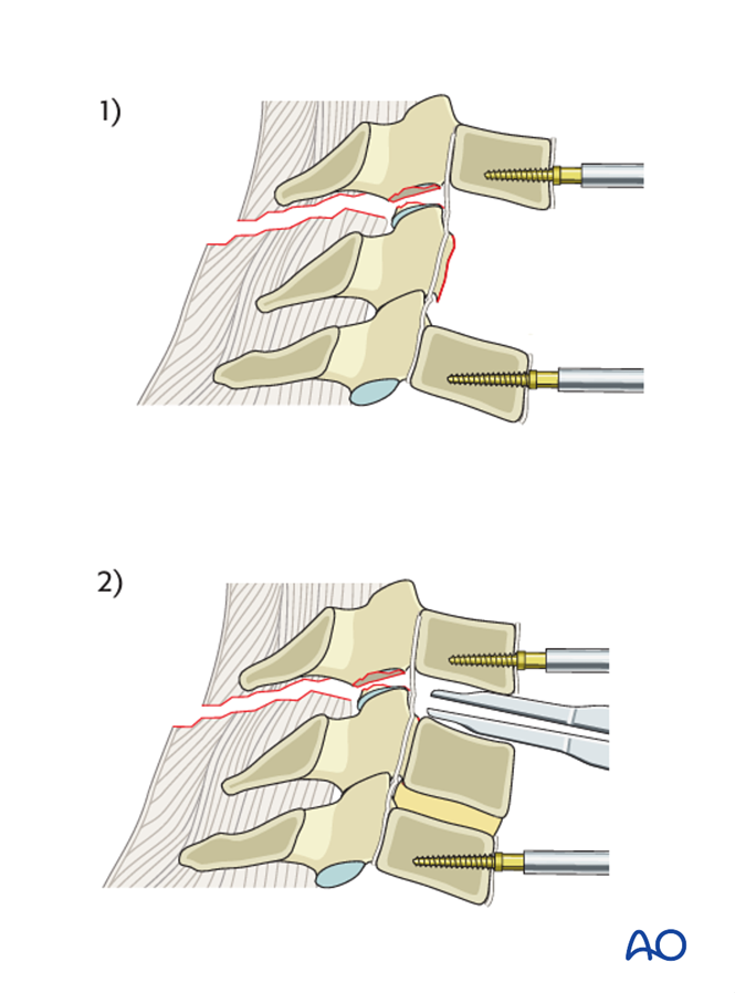 Anterior plating for C Translational injury