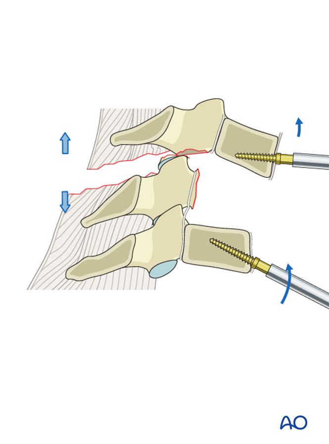 Anterior plating for C Translational injury