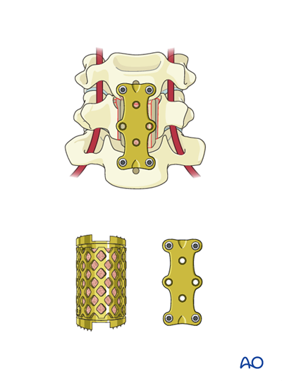 Anterior plating