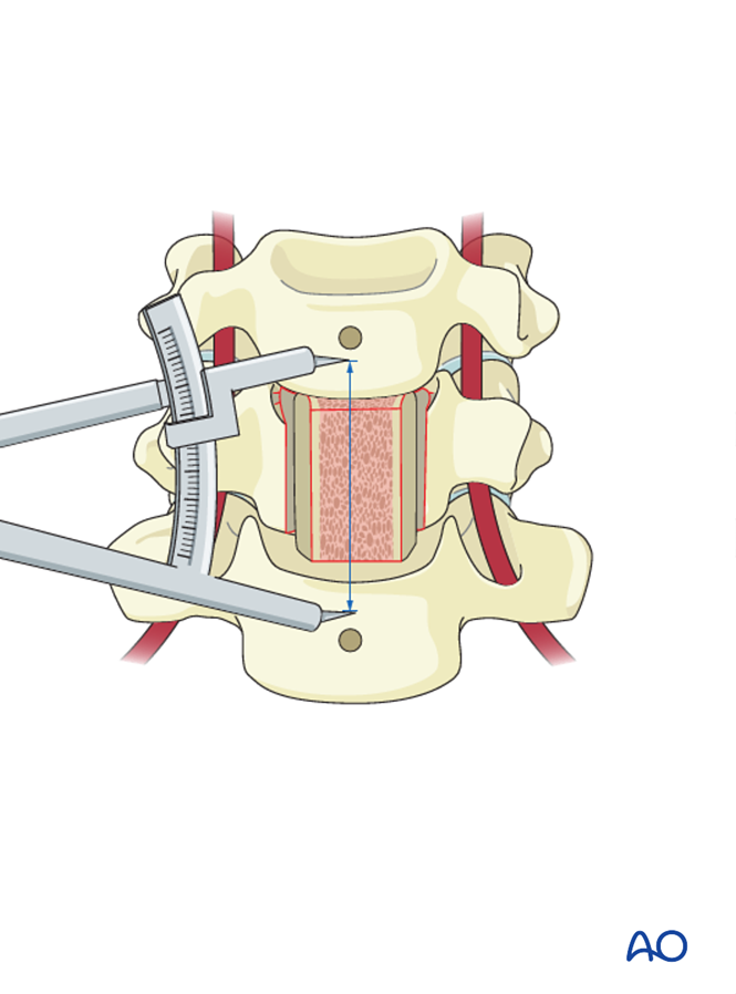 Anterior plating for B3 Anterior tension band injury