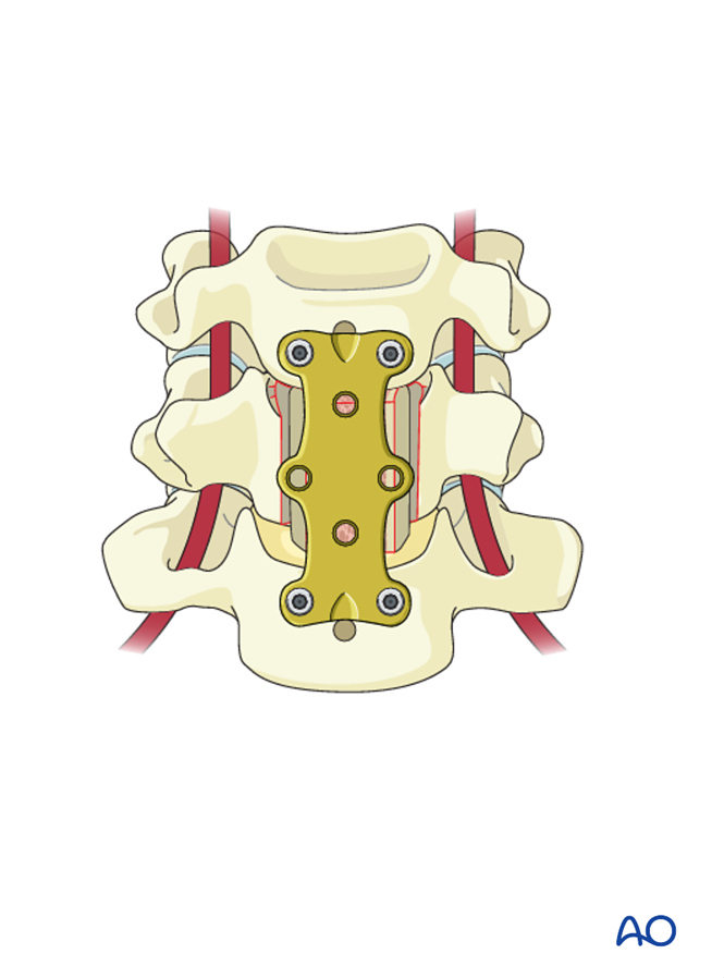 Anterior plating for B3 Anterior tension band injury