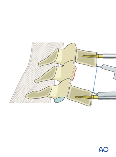 Anterior plating