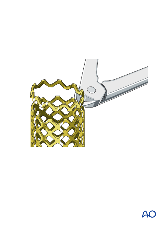 Anterior plating