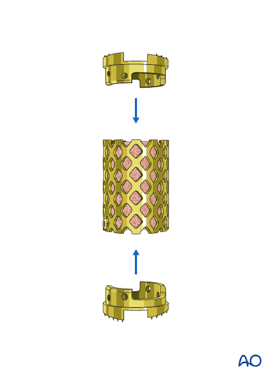 Anterior plating