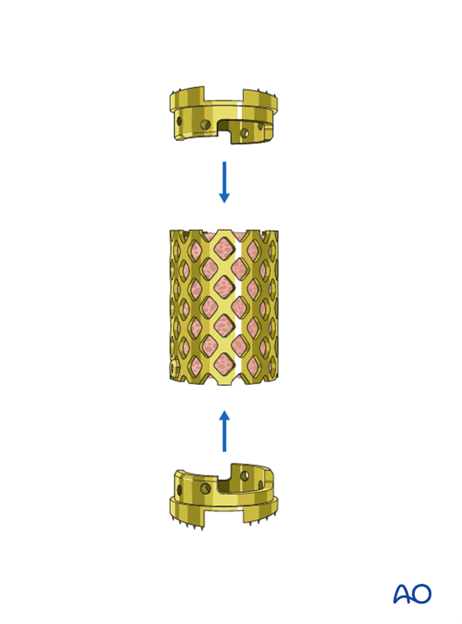 Anterior plating for B3 Anterior tension band injury
