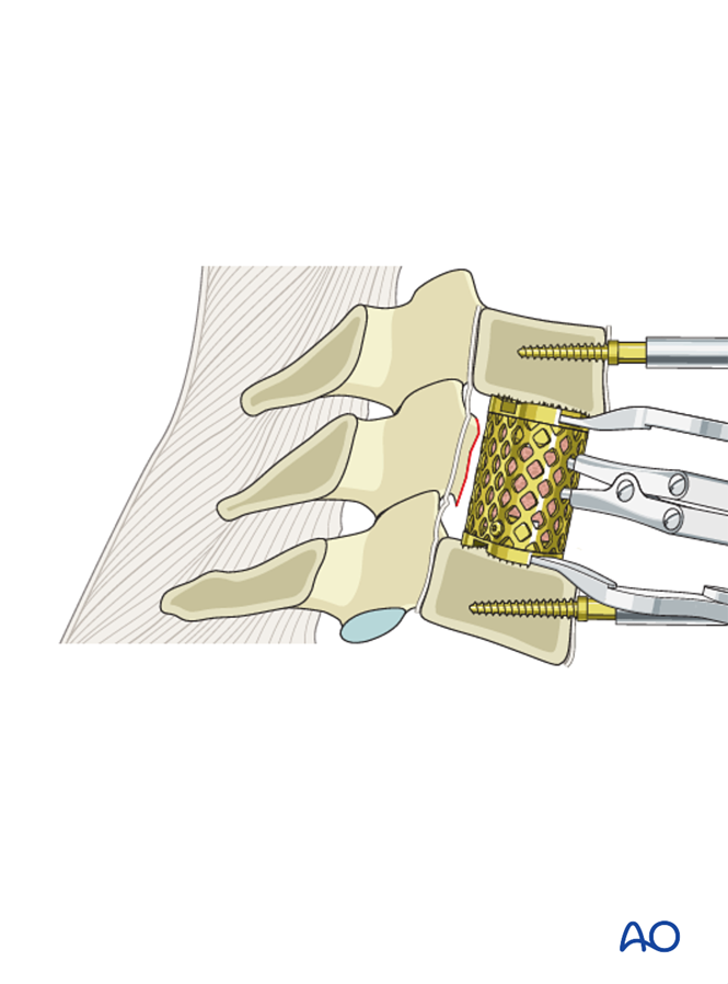 Anterior plating