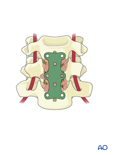 Anterior plating for B3 Anterior tension band injury