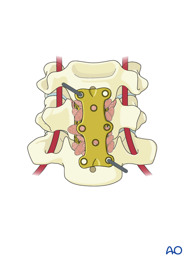 Anterior plating