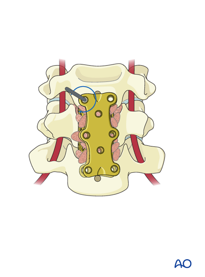 Anterior plating for B2 Posterior tension band injury (bony ...