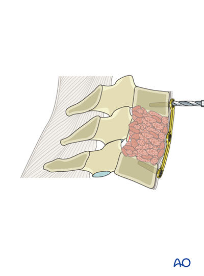 Anterior plating